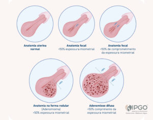 Adenomiose | IPGO