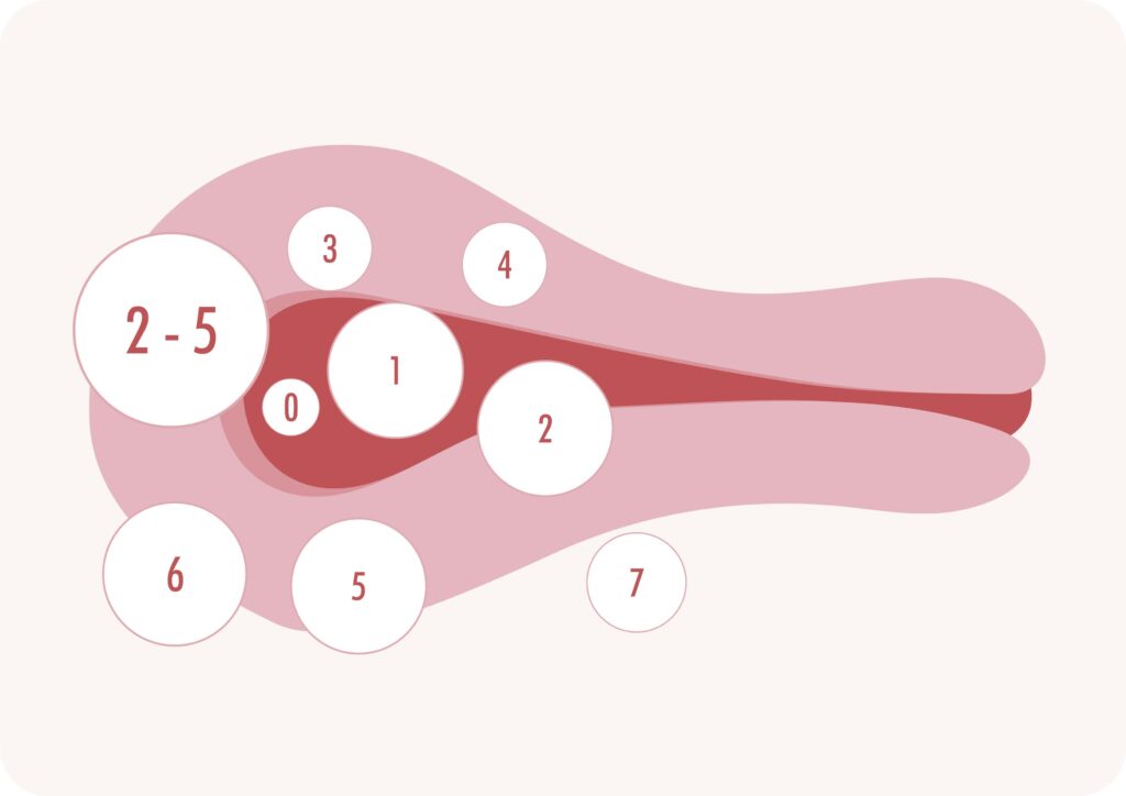 Miomas uterinos e a infertildade | IPGO